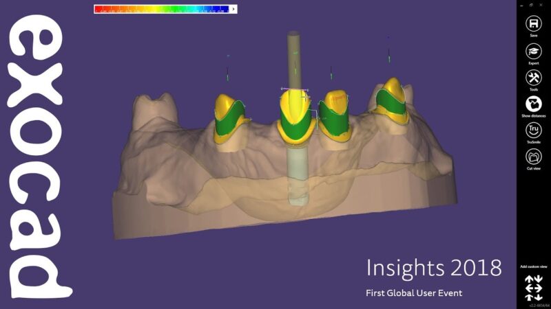 Exocad | Advanced CAD/CAM Software for Digital Dentistry